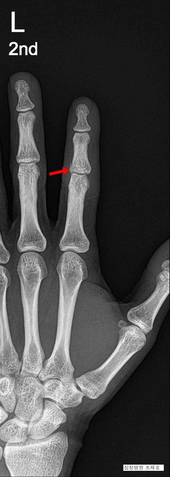 손가락의 근위지 관절 골절 탈구에서의 관혈적 정복술 및 내고정술orif At Finger Pip Joint Fracture