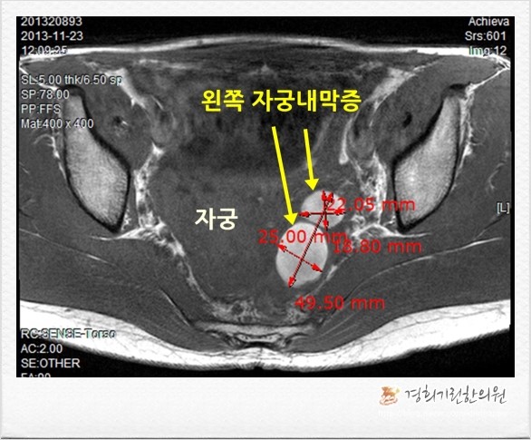 자궁내막증의 Mri정밀검사와 한방치료 28년 노하우 네이버 블로그