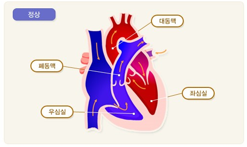 팔로 네증후 팔로사징후 Tetralogy Of Fallot 폐동맥 판막 심장판막 재수술 네이버 블로그
