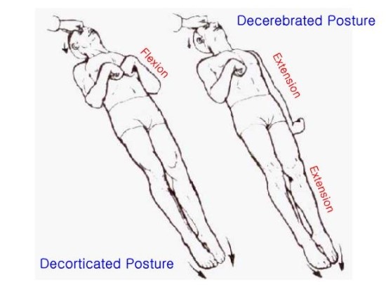 decerebrate and decorticate postures : 네이버 블로그