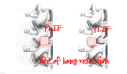 PLIF 과 TLIF의 비교 : 네이버 블로그